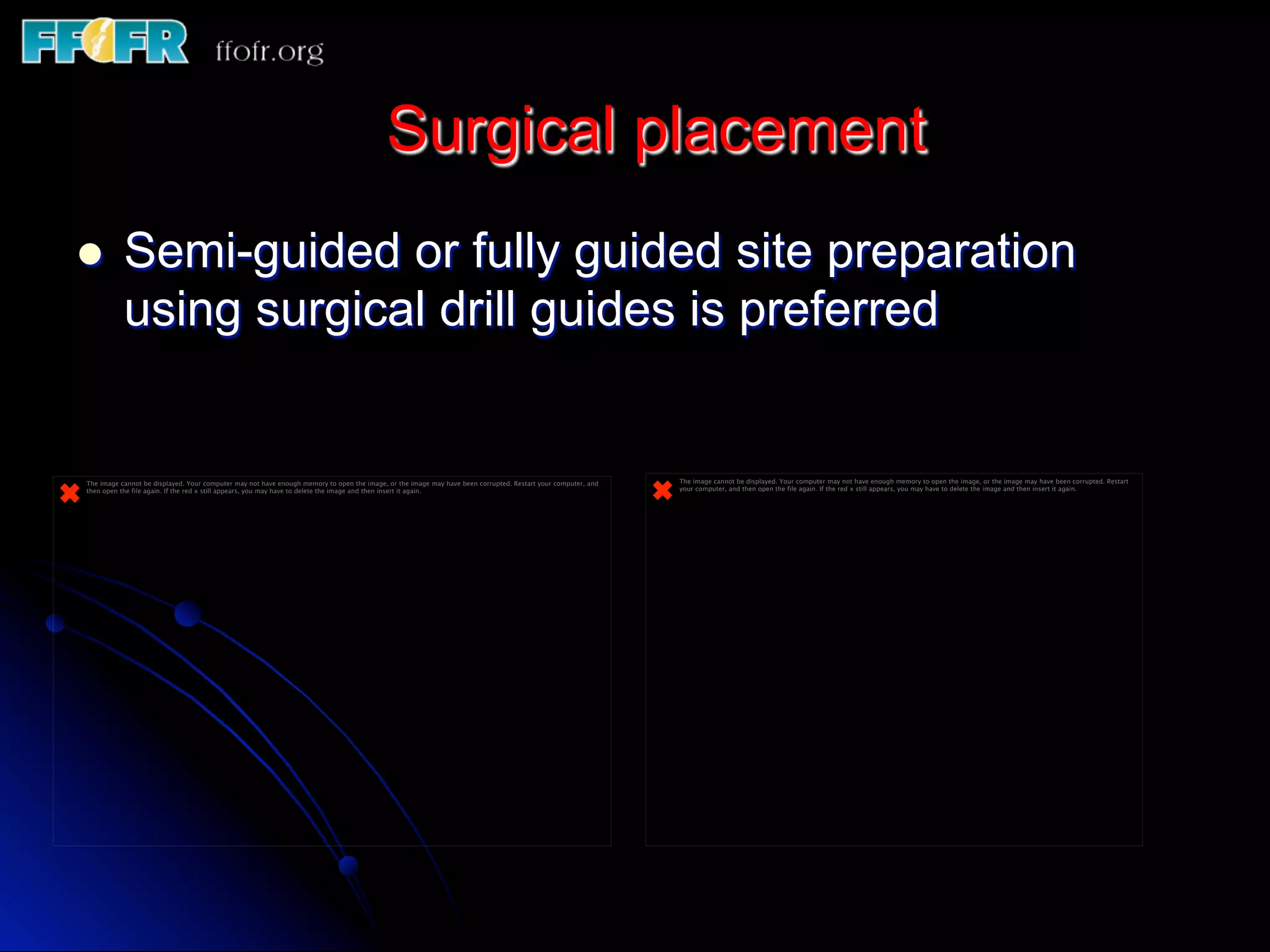 Single tooth defects in the posterior quadrants | PPT