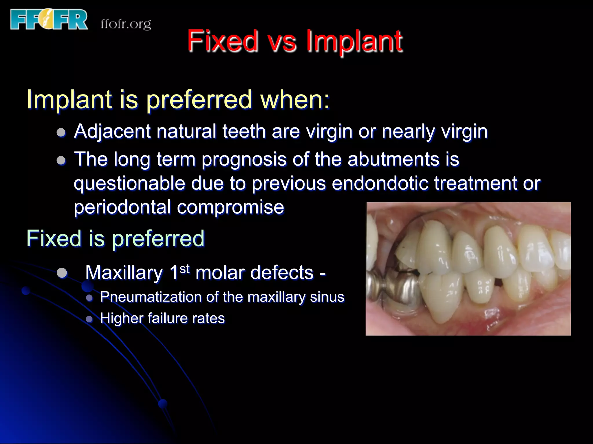 Single tooth defects in the posterior quadrants | PPT