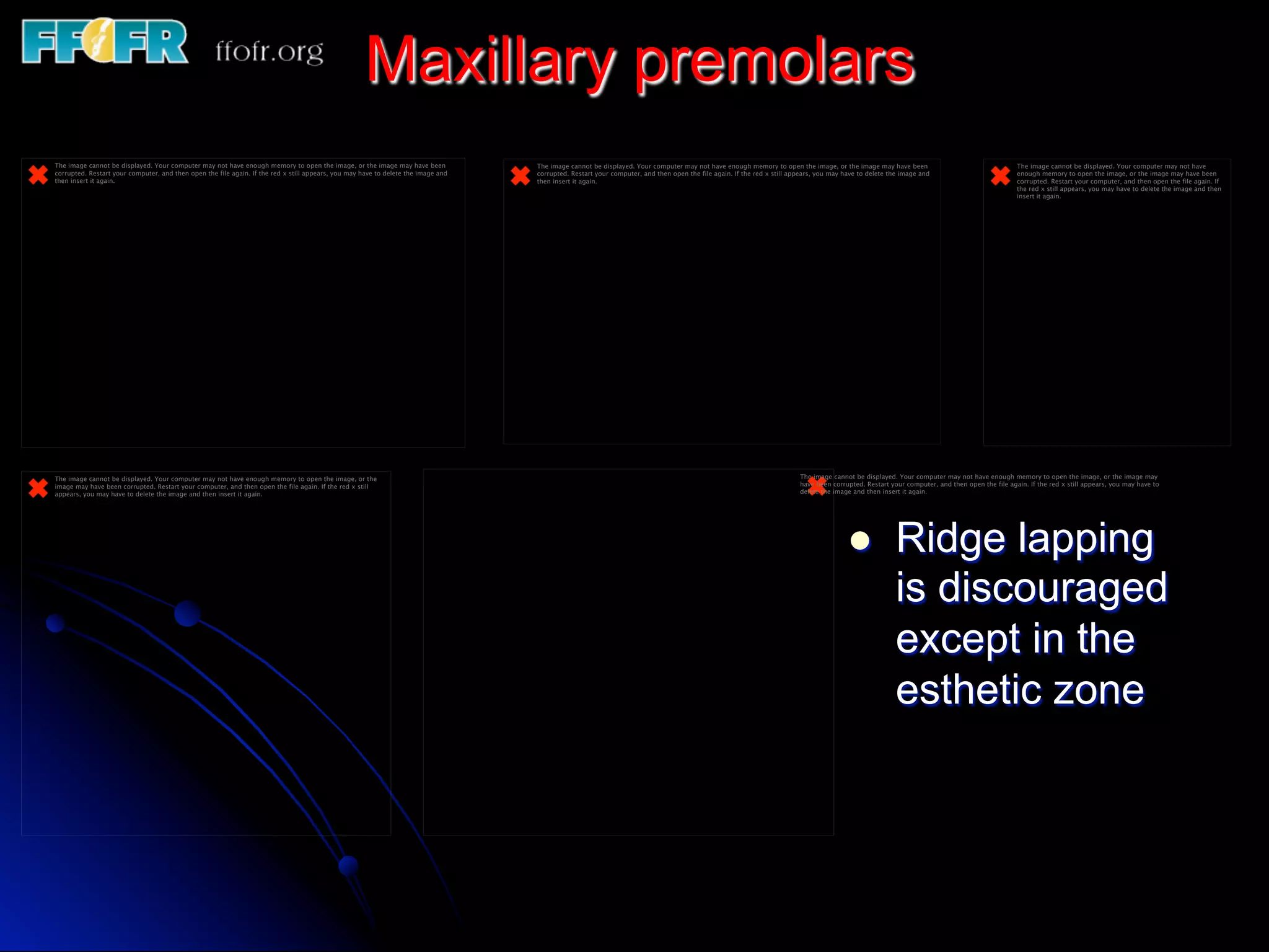 Single tooth defects in the posterior quadrants | PPT