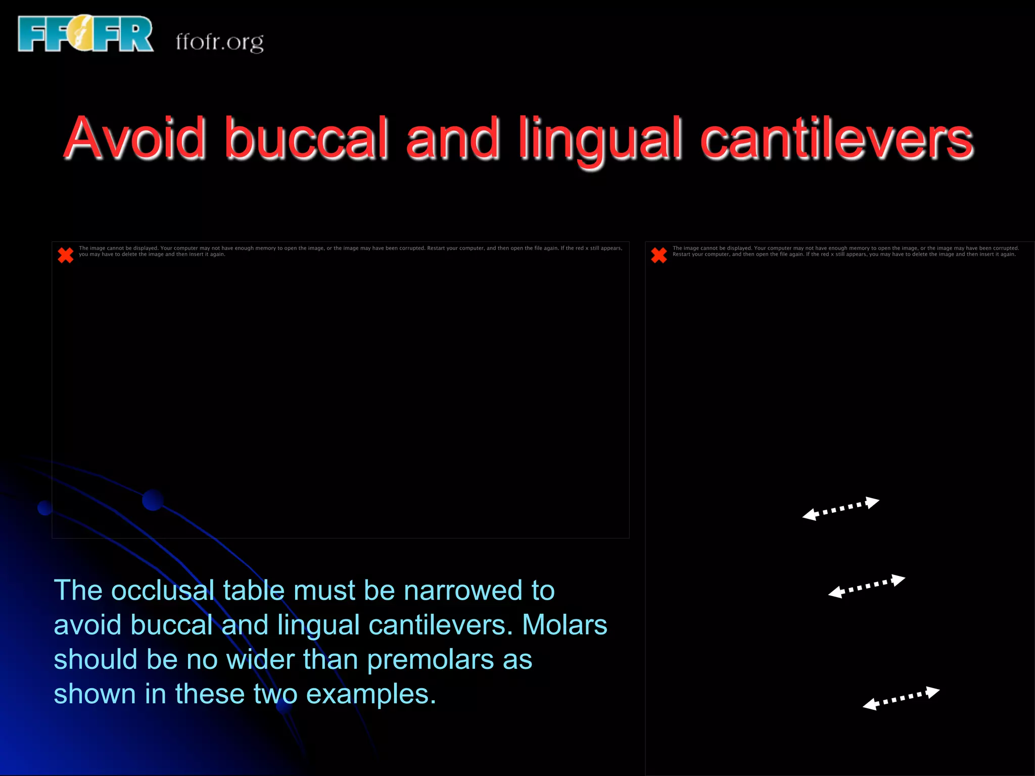 Single tooth defects in the posterior quadrants | PPT