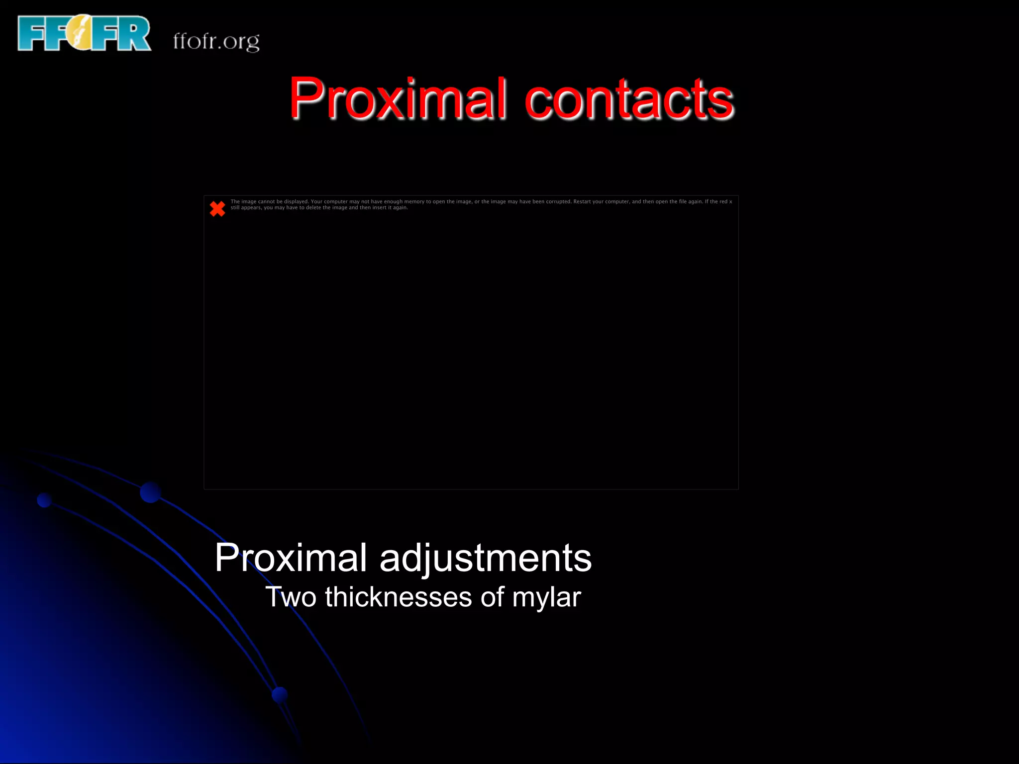Single tooth defects in the posterior quadrants | PPT