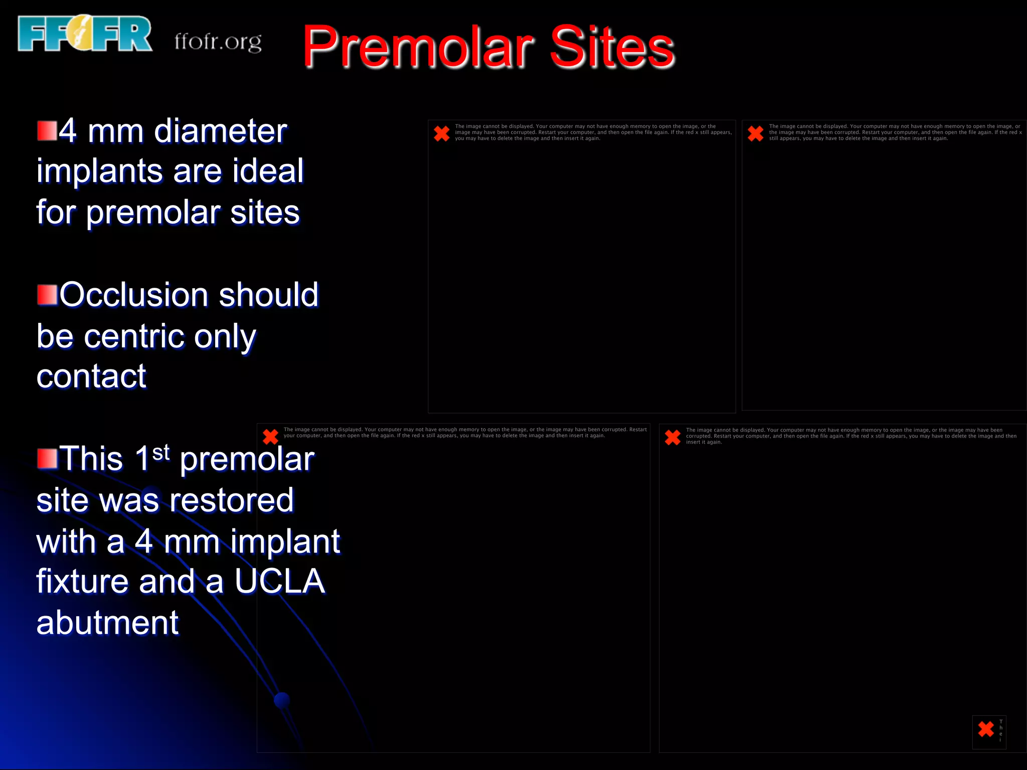 Single tooth defects in the posterior quadrants | PPT