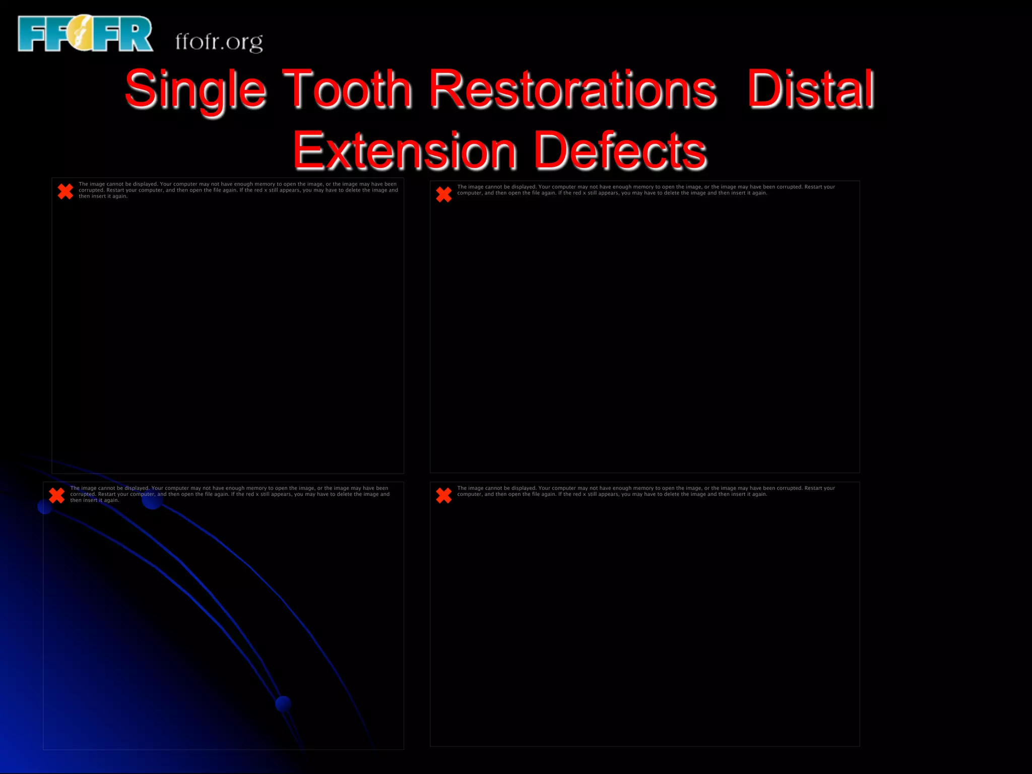 Single tooth defects in the posterior quadrants | PPT