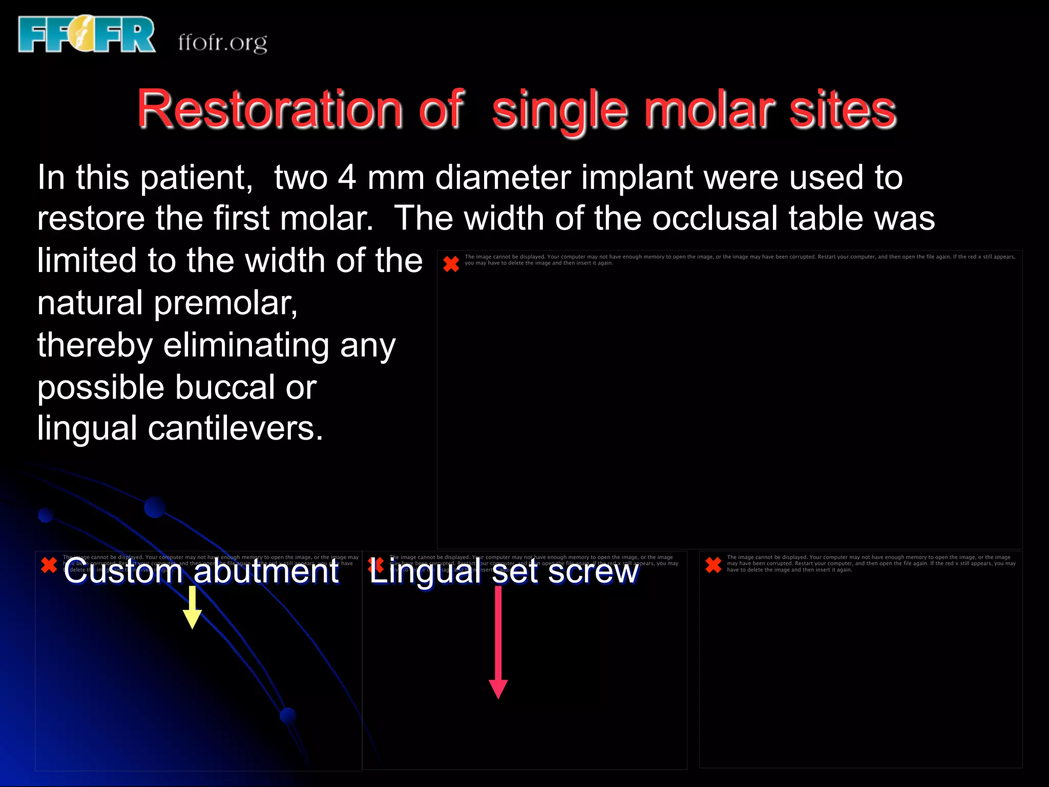Single tooth defects in the posterior quadrants | PPT