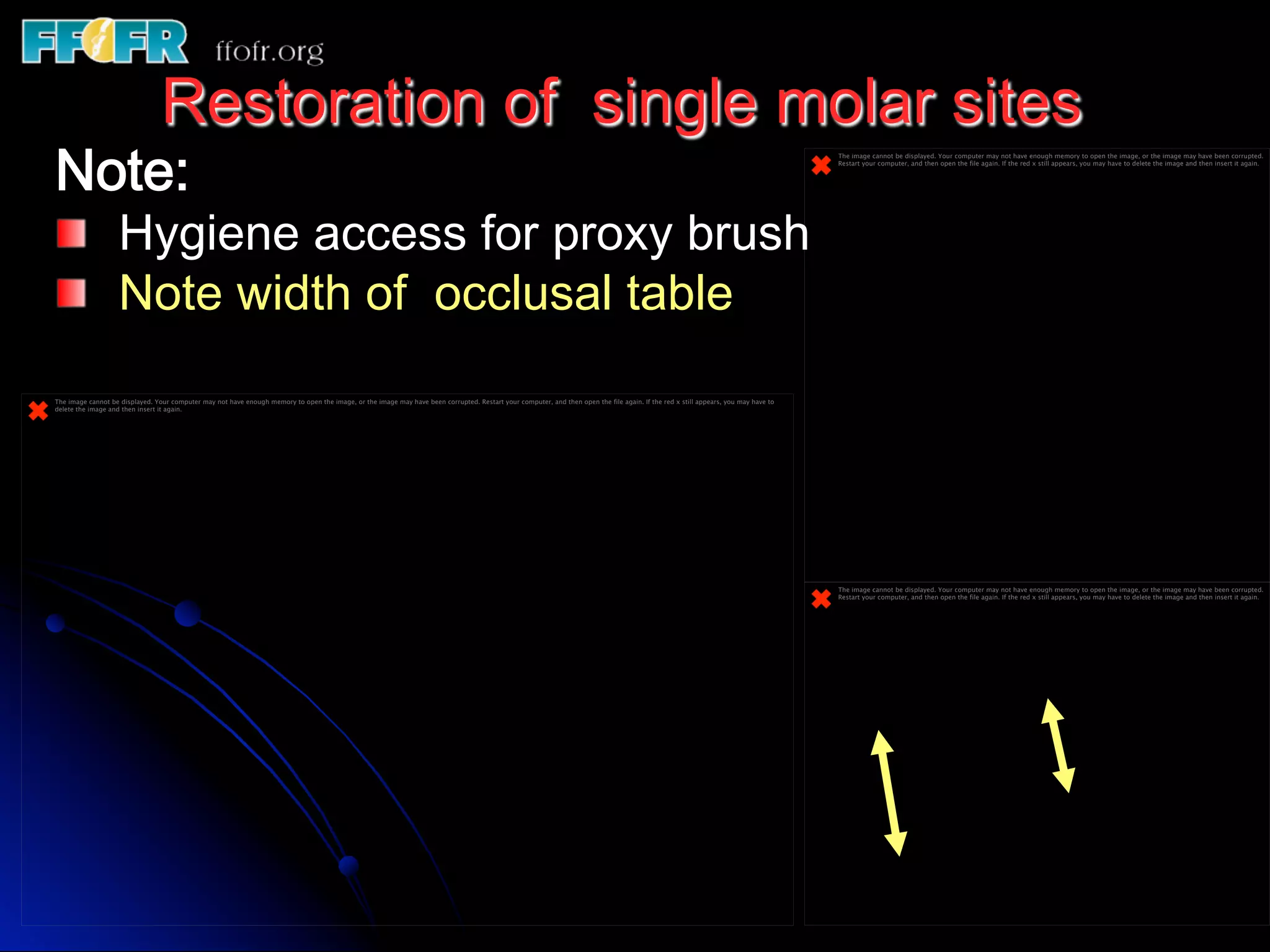 Single tooth defects in the posterior quadrants | PPT