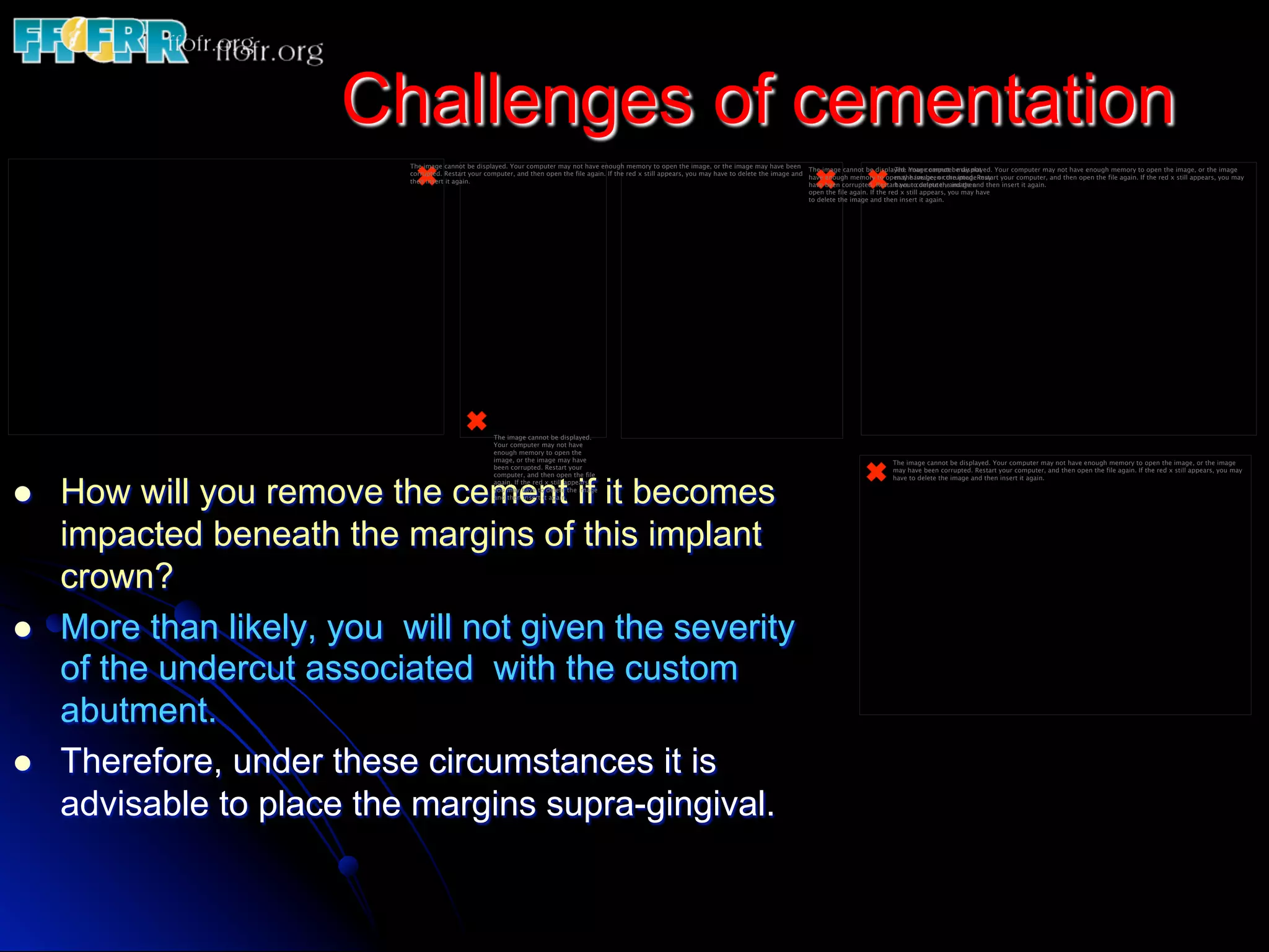 Single tooth defects in the posterior quadrants | PPT