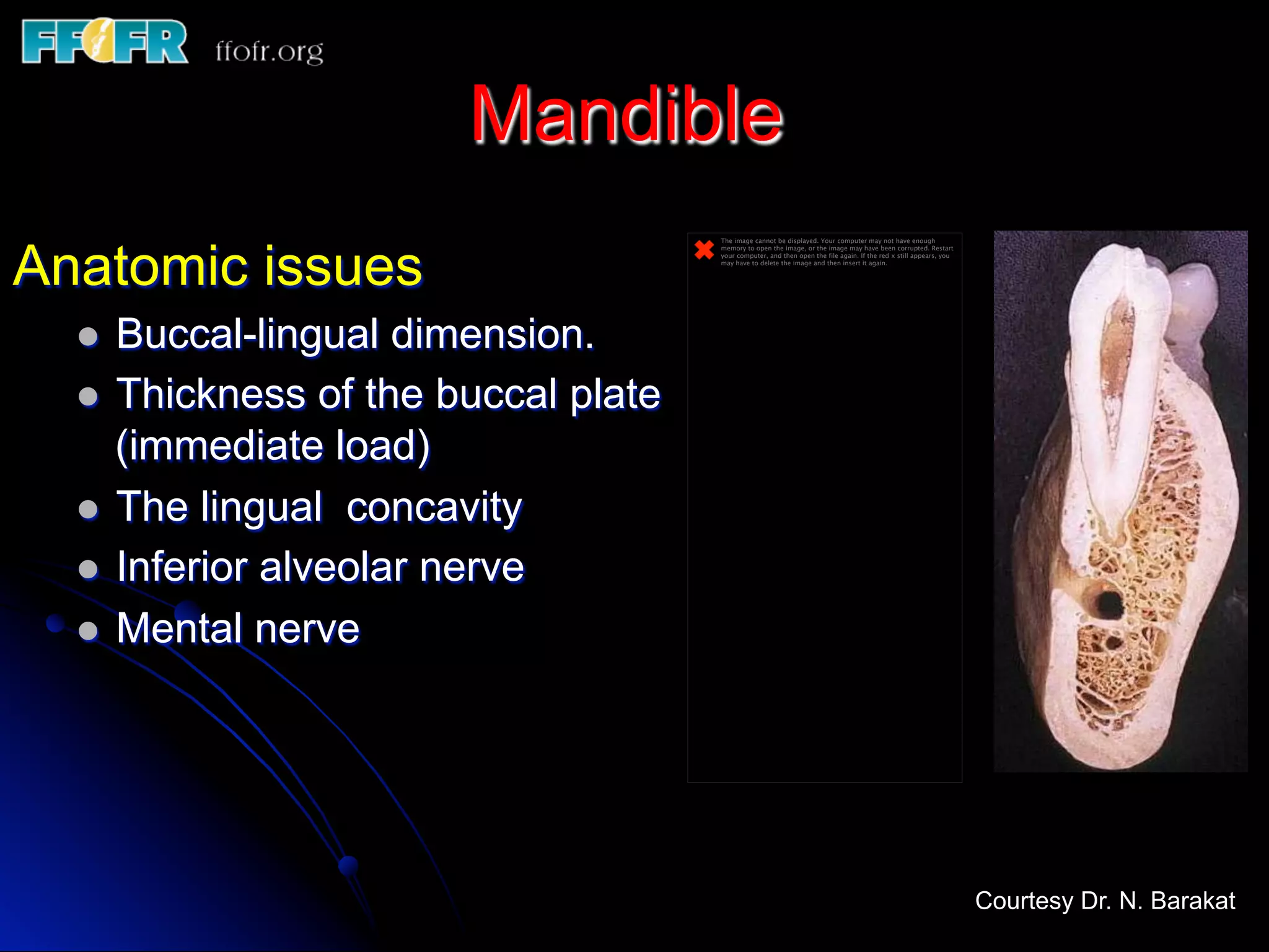 Single tooth defects in the posterior quadrants | PPT
