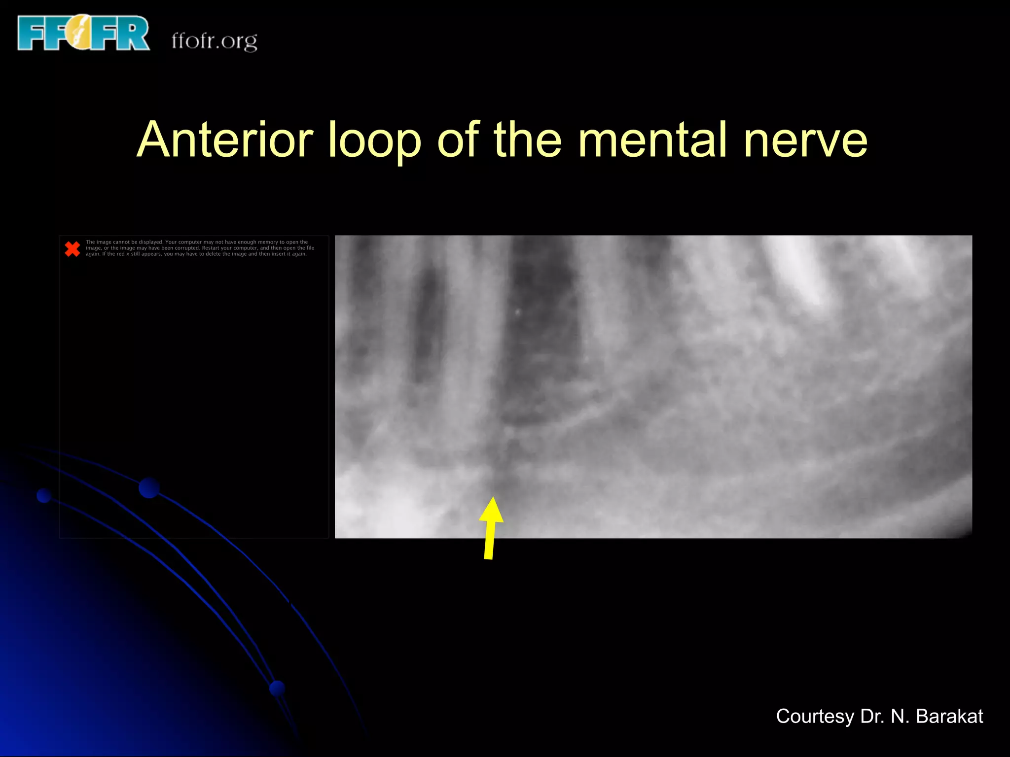 Single tooth defects in the posterior quadrants | PPT
