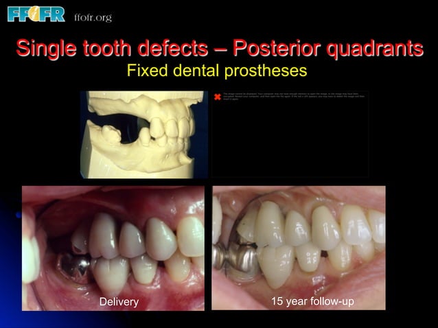 Single tooth defects in the posterior quadrants | PPT