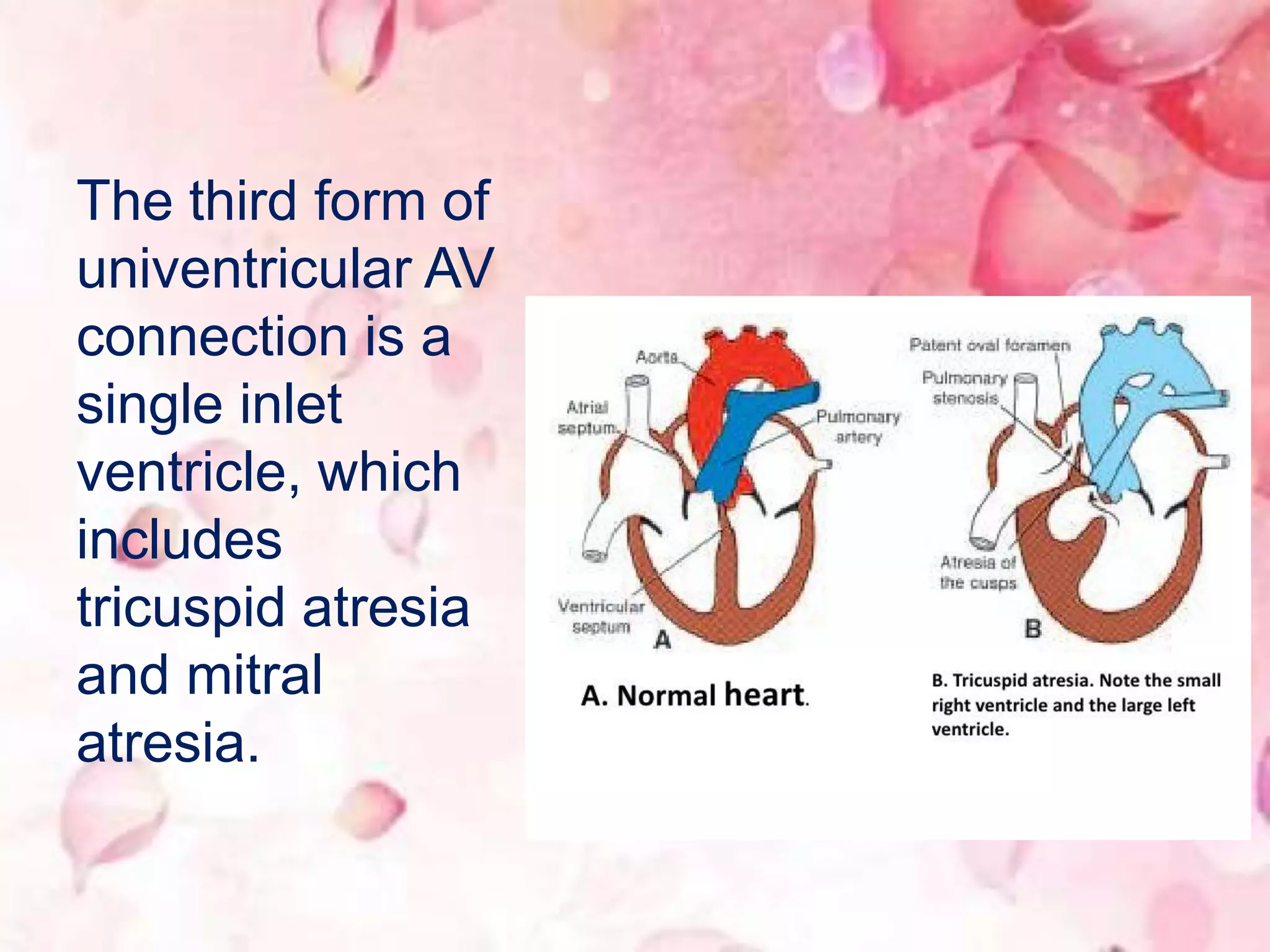 Single ventricle | PPTX