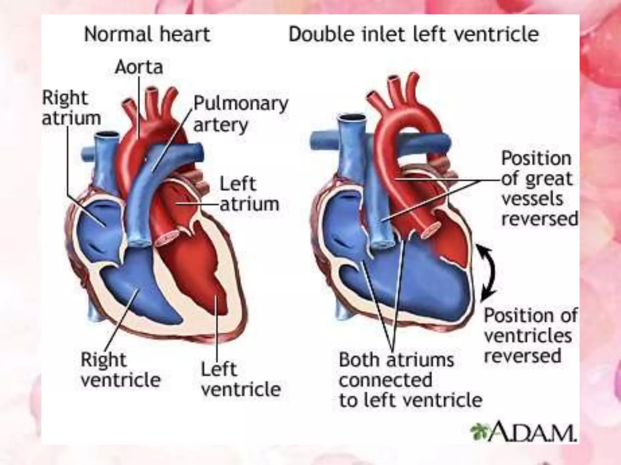 Single ventricle | PPTX