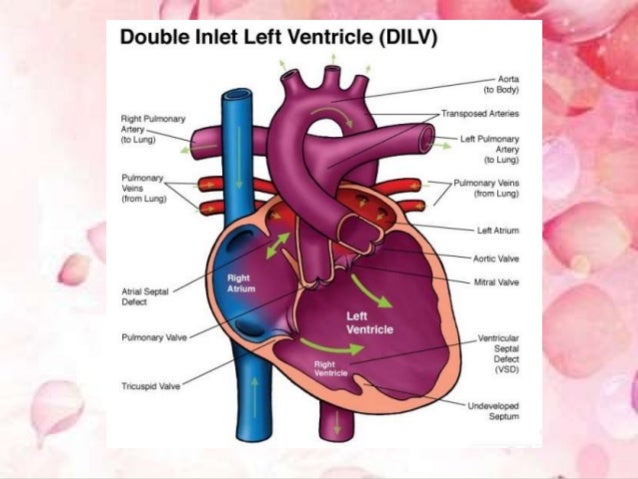 Single ventricle
