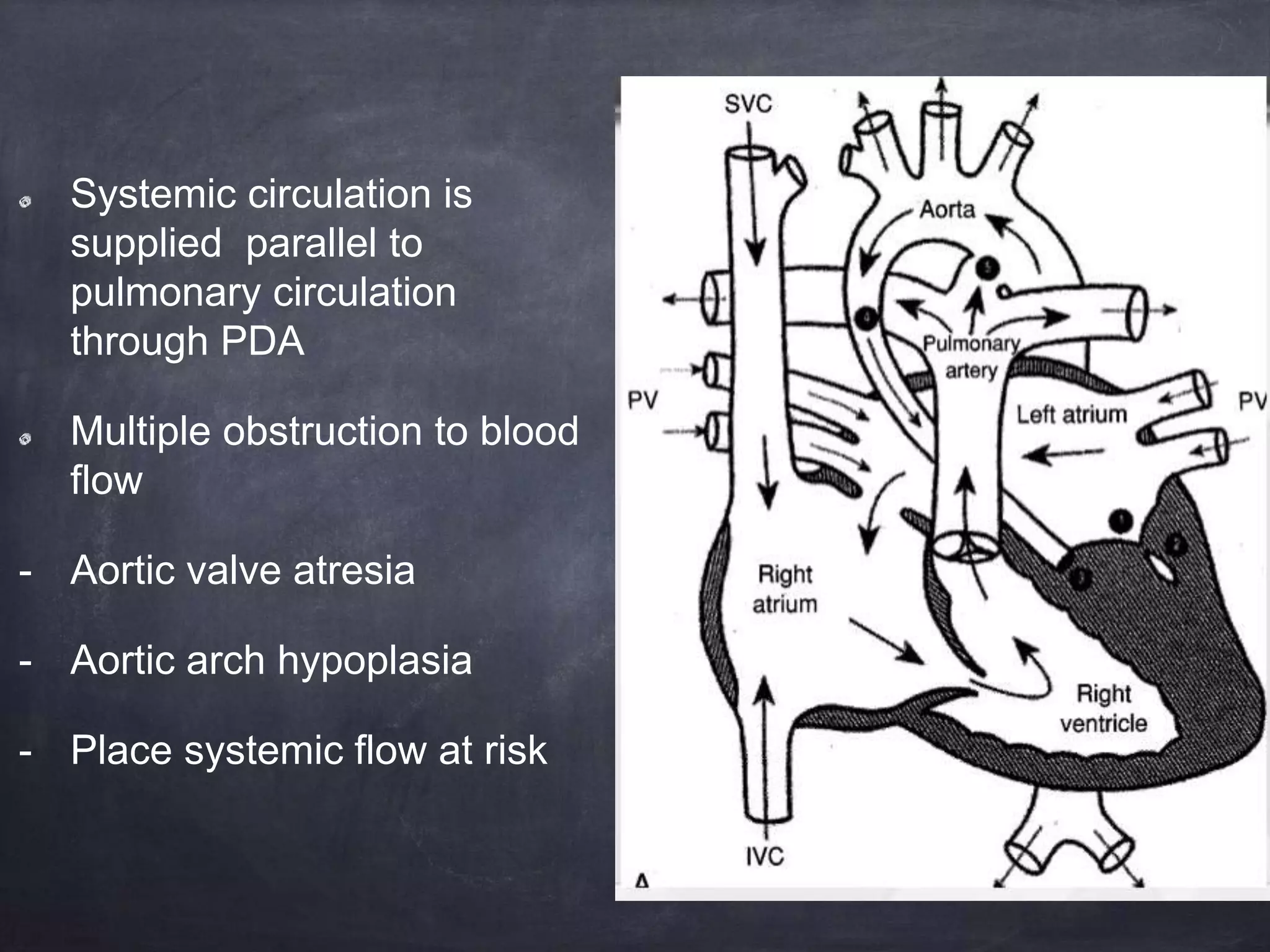single ventricle physiology | PPT