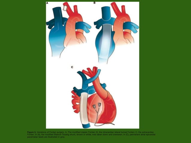 single ventricle physiology | PPT