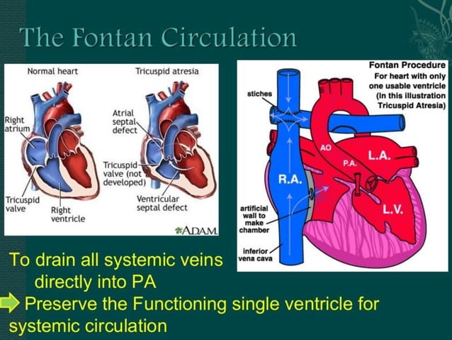 single ventricle physiology | PPT