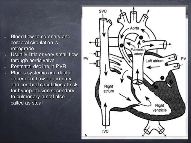 single ventricle physiology