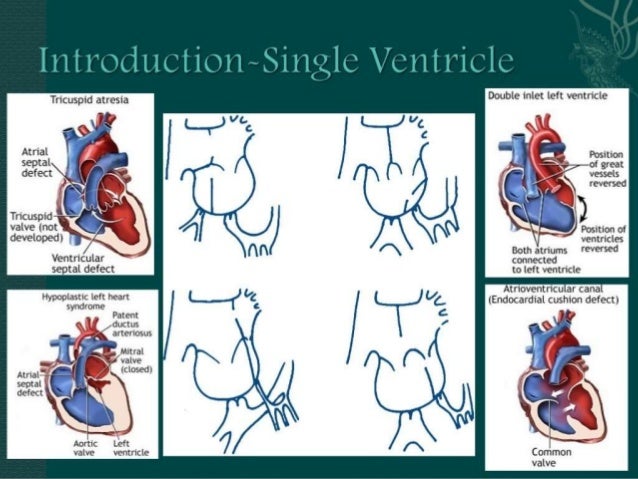 single ventricle physiology