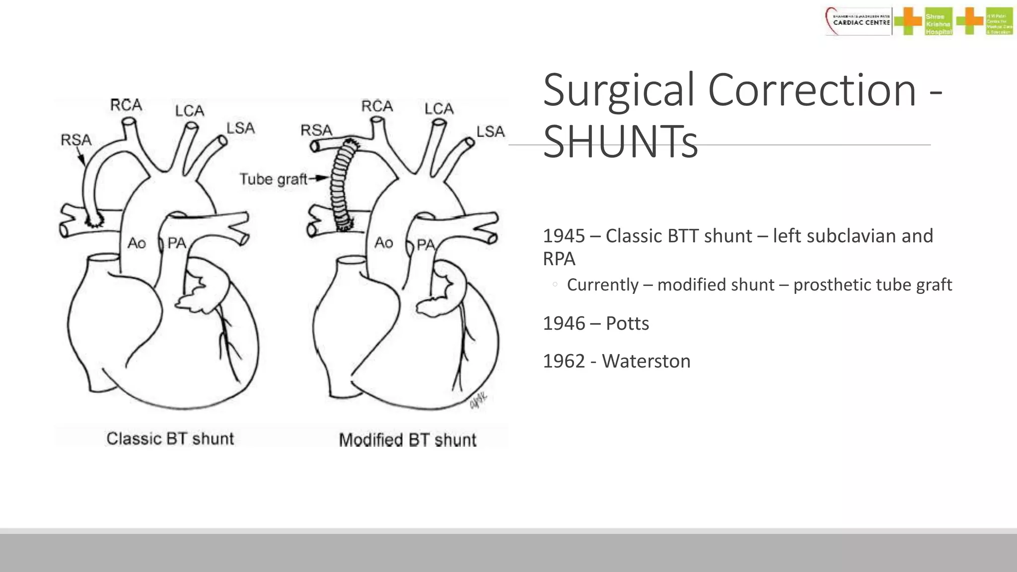 Single ventricle palliation | PPTX