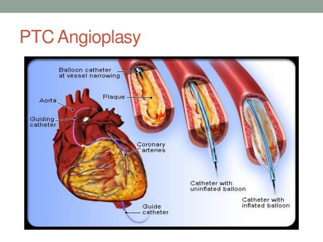 Single vessel disease