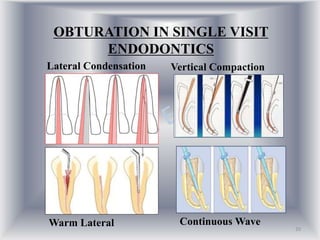 Single visit Endodontics, Sunil M Eraly, Malabar Dental College and ...