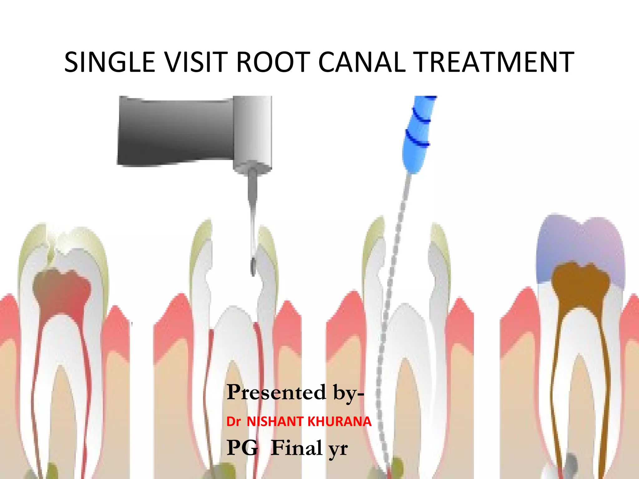 Single visit endodontics | PPT