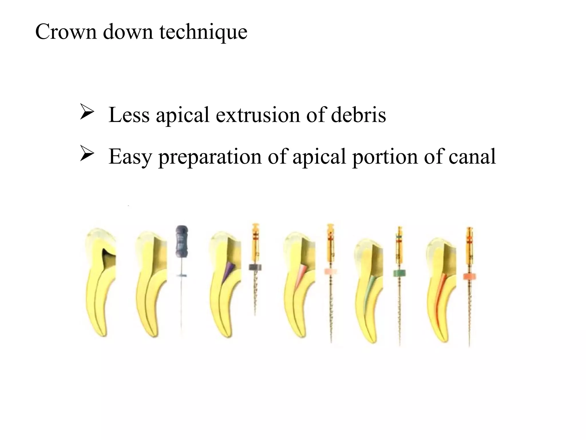 Single visit endodontics | PPT