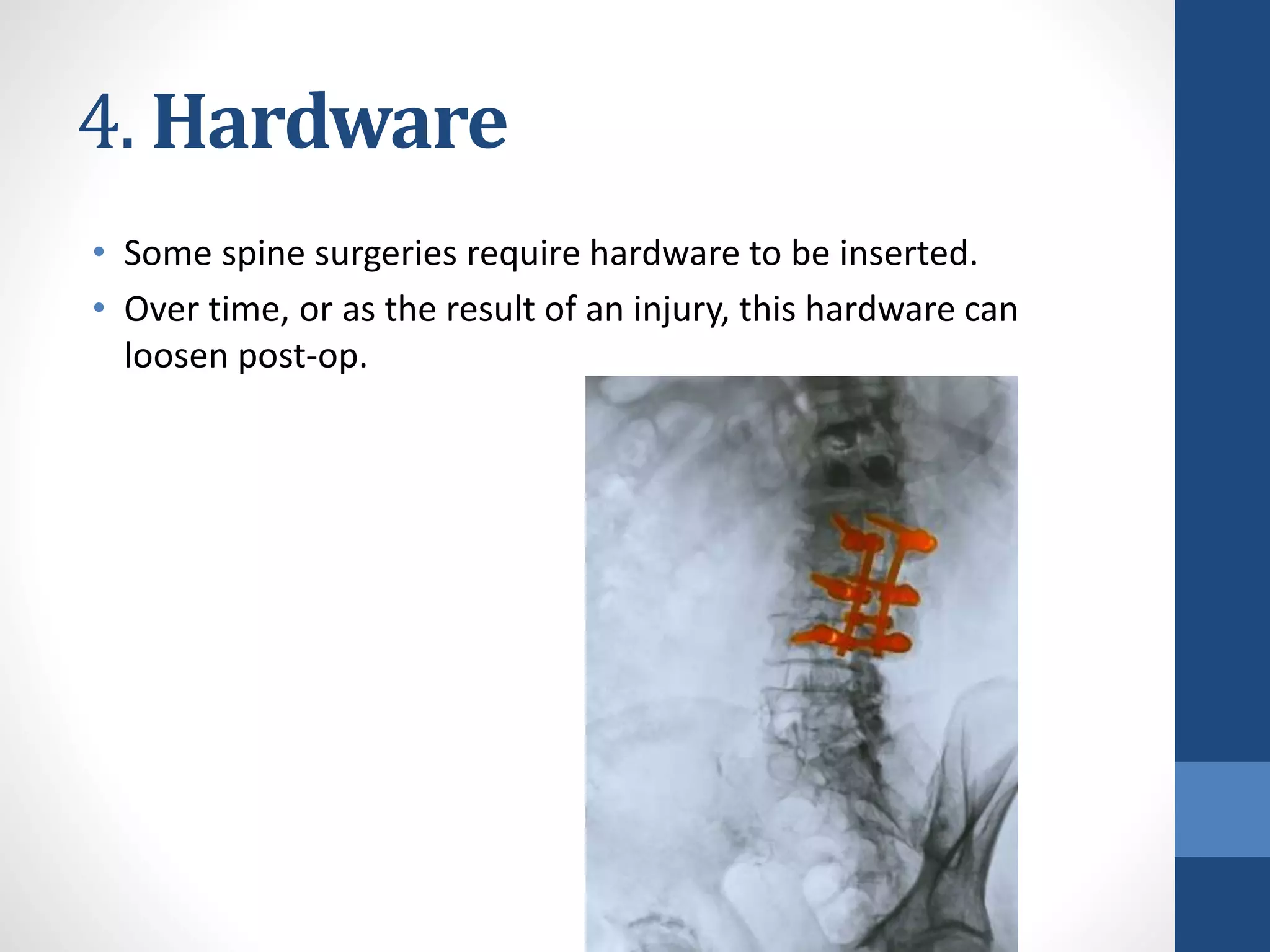 4 Spine Surgery Complications | PPTX