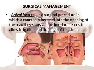 Nursing management of patient withSINISITIS | PPTX