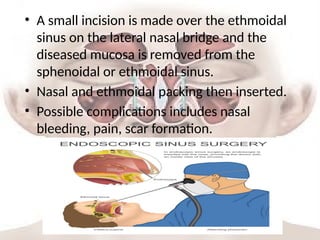 Nursing management of patient withSINISITIS | PPTX
