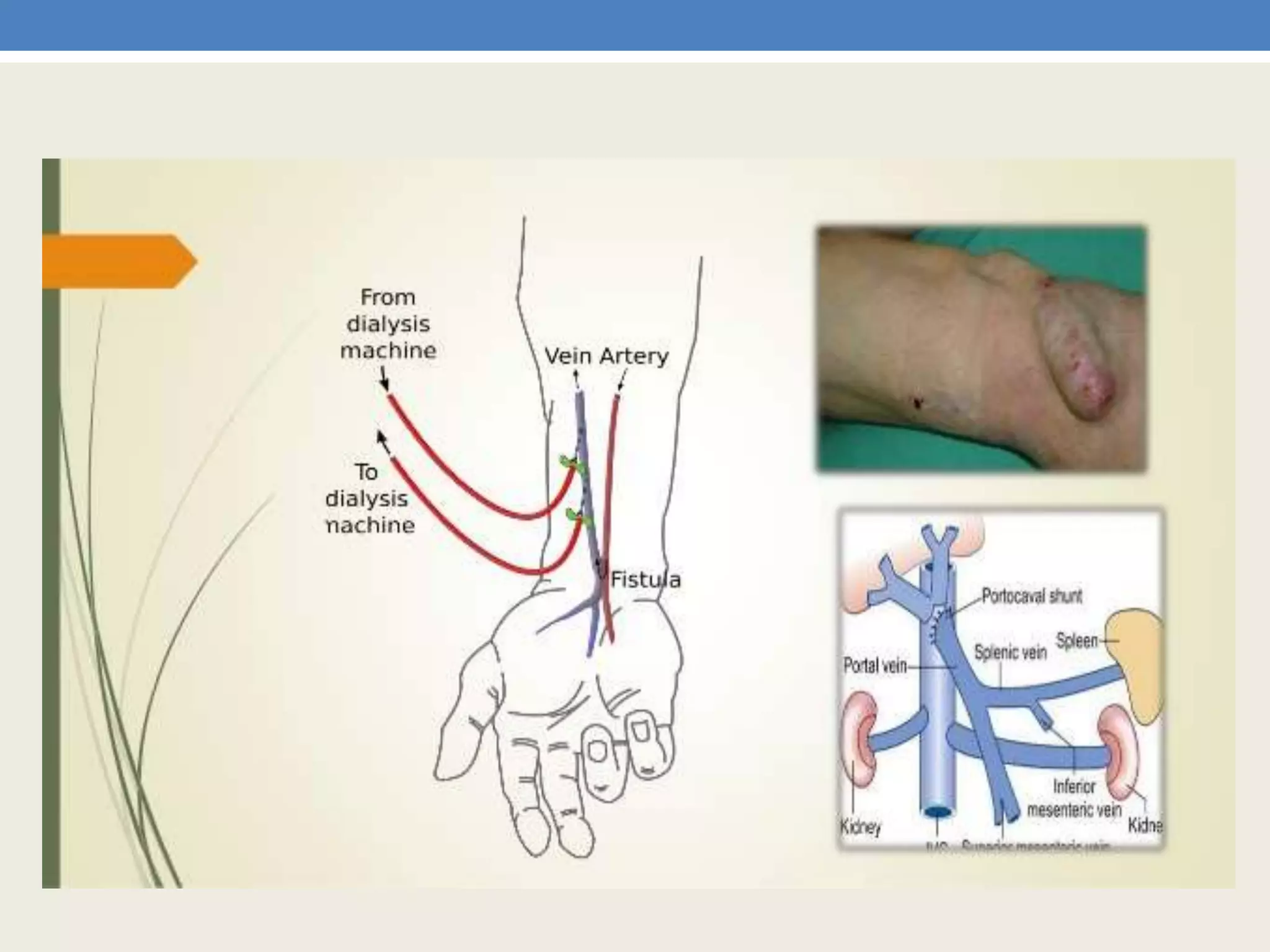 Sinogram and fistulogram | PPTX