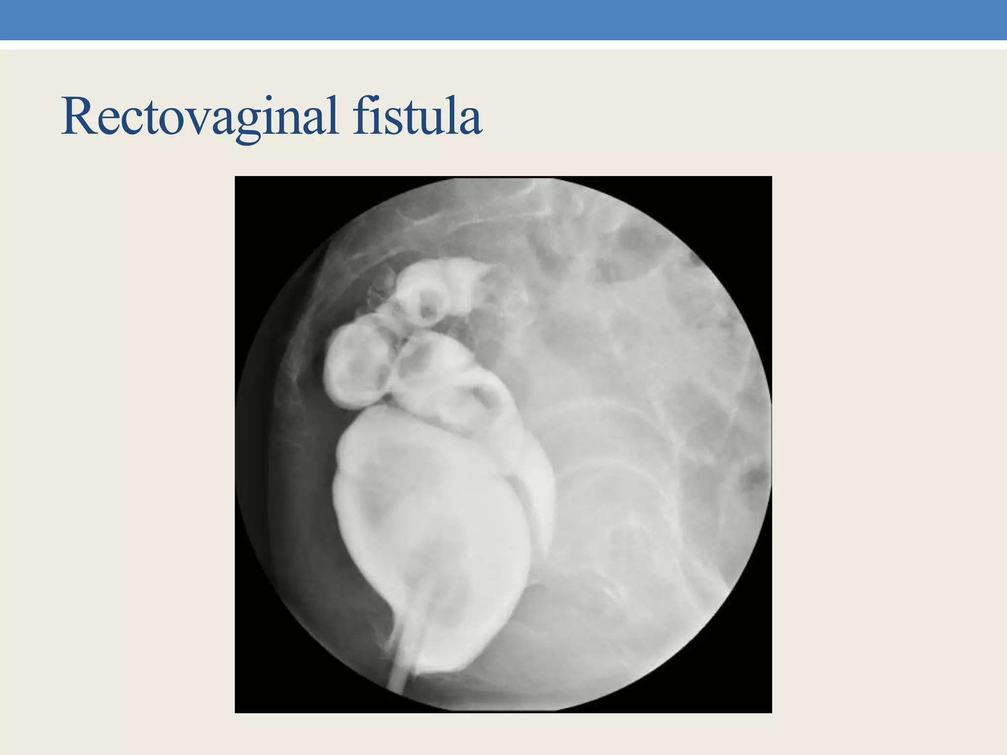 Sinogram and fistulogram | PPTX