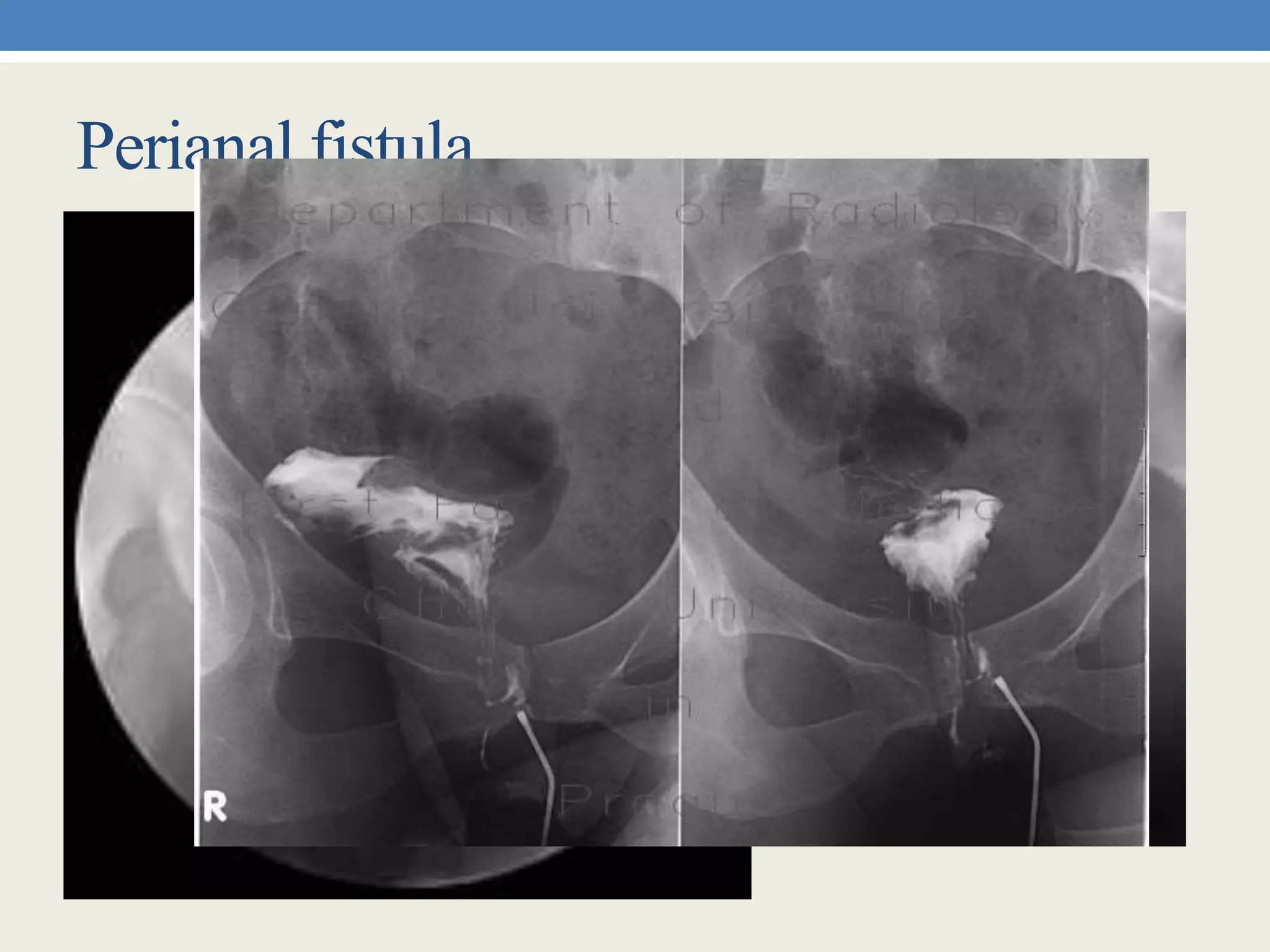 Sinogram and fistulogram | PPTX