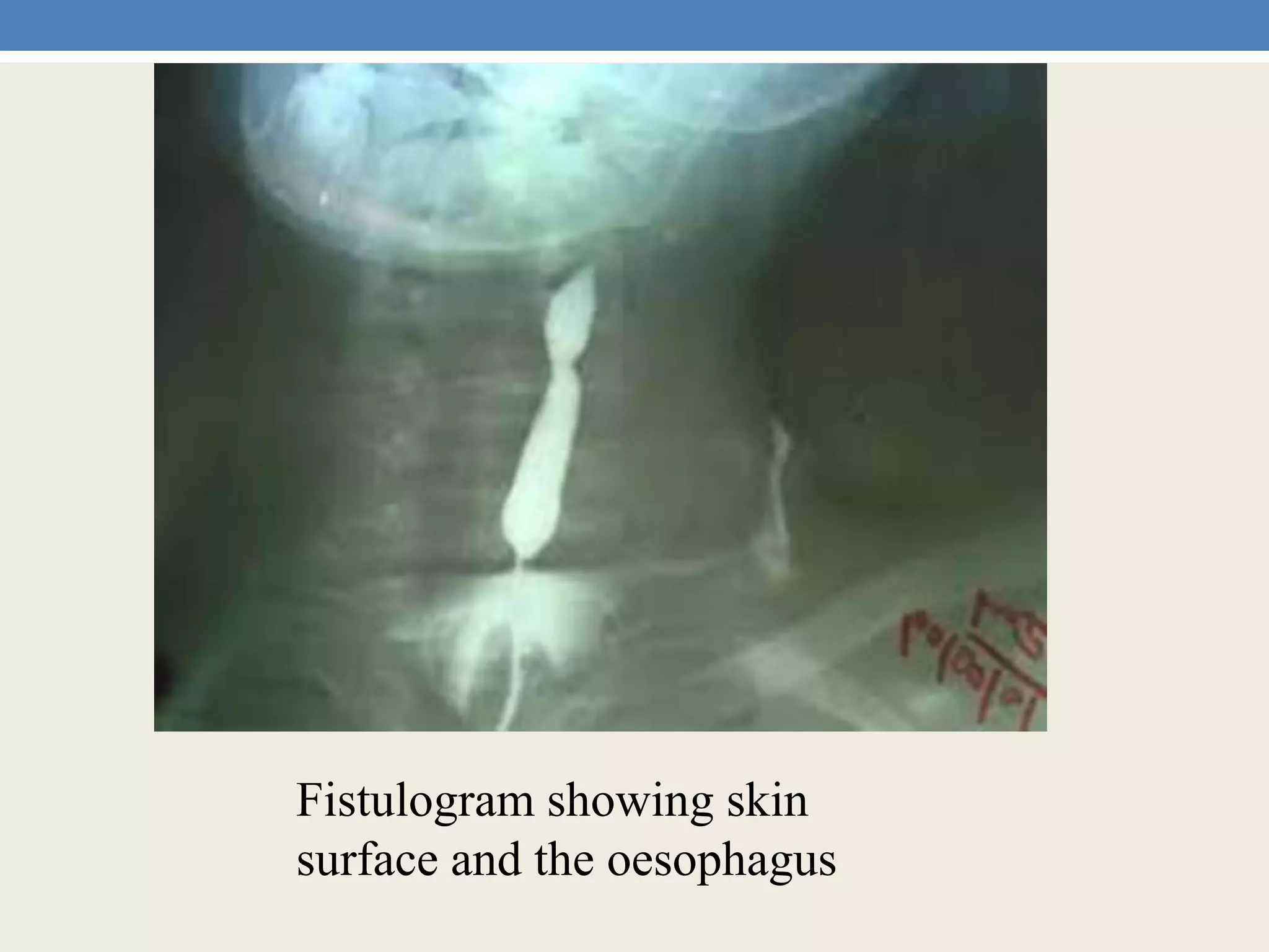 Sinogram and fistulogram | PPTX