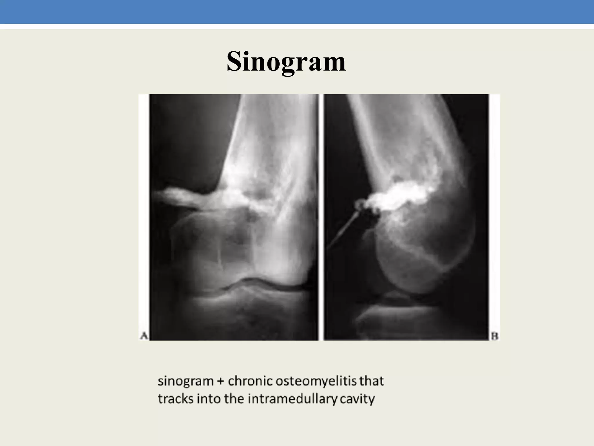 Sinogram and fistulogram | PPTX