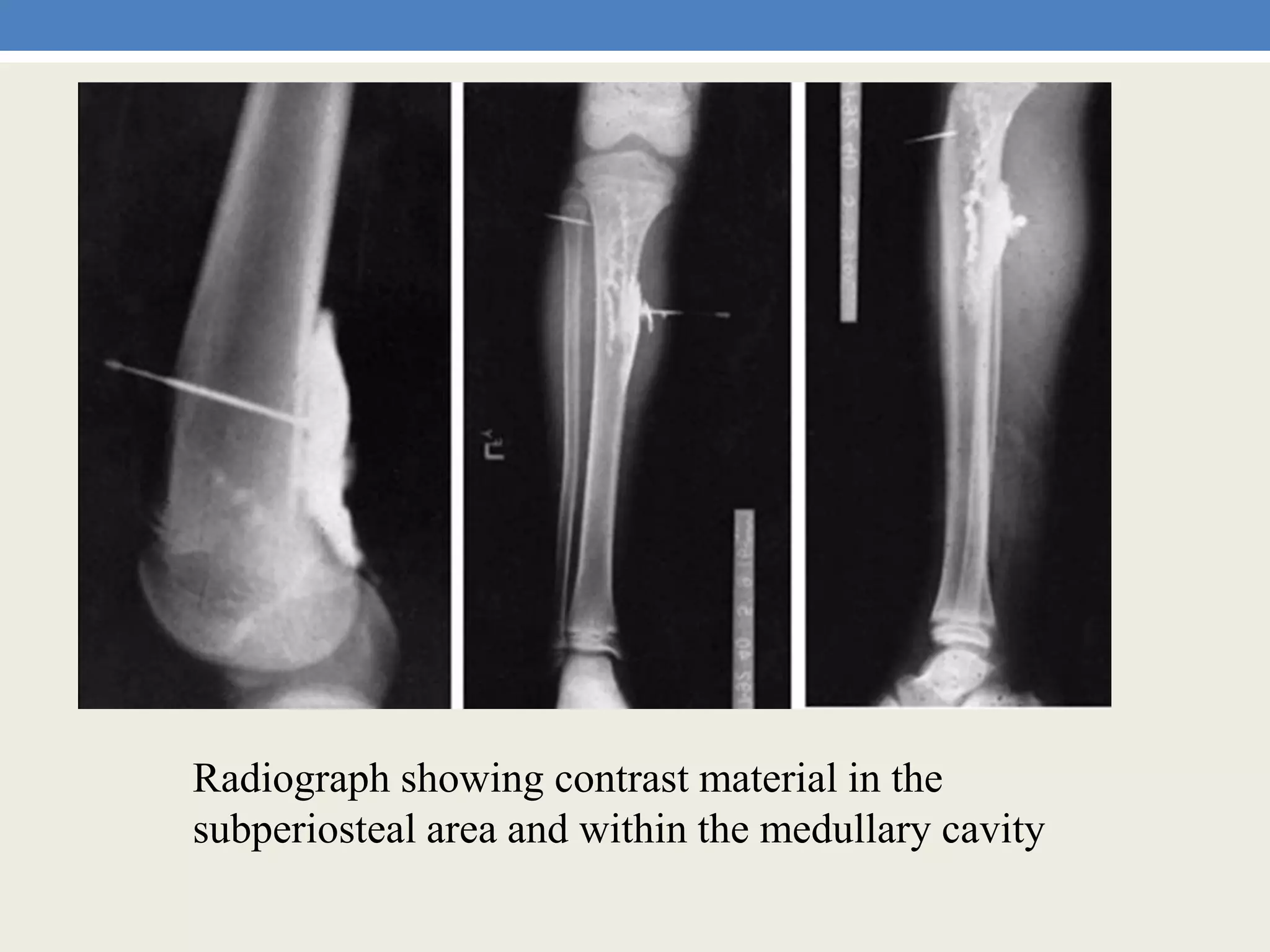 Sinogram and fistulogram | PPTX
