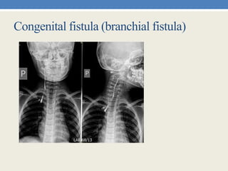 Sinogram and fistulogram | PPTX