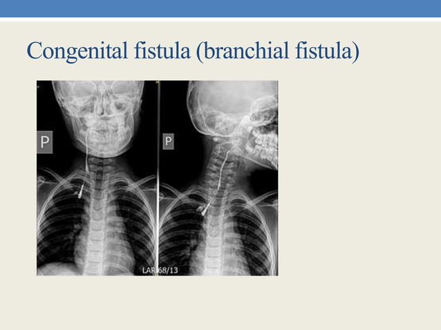Sinogram and fistulogram | PPTX