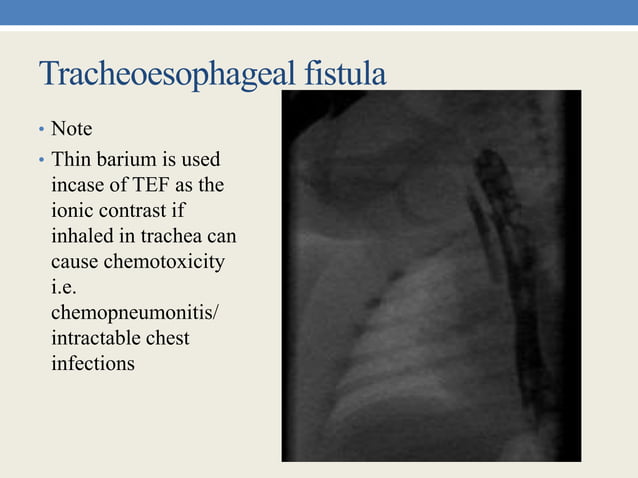 Sinogram and fistulogram | PPTX