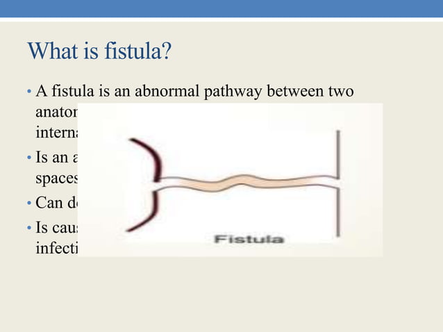 Sinogram and fistulogram | PPTX