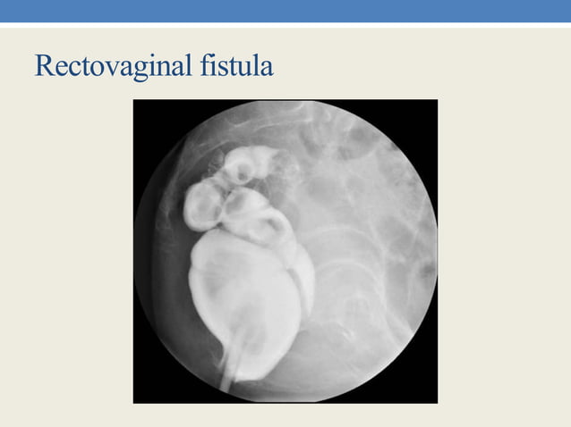 Sinogram and fistulogram | PPTX