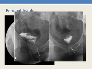 Sinogram and fistulogram | PPTX