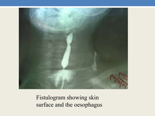 Sinogram and fistulogram | PPTX