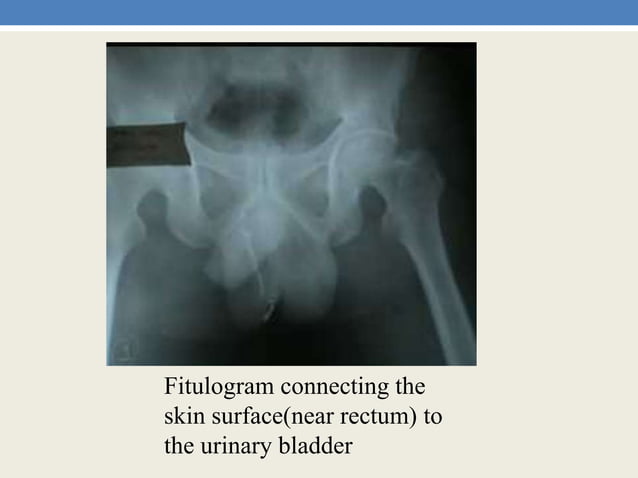 Sinogram and fistulogram