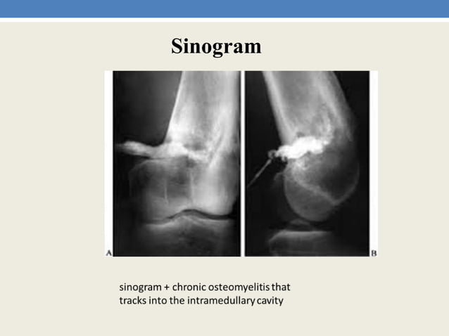 Sinogram and fistulogram