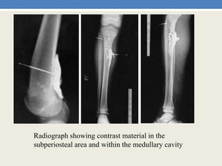 Sinogram and fistulogram | PPT