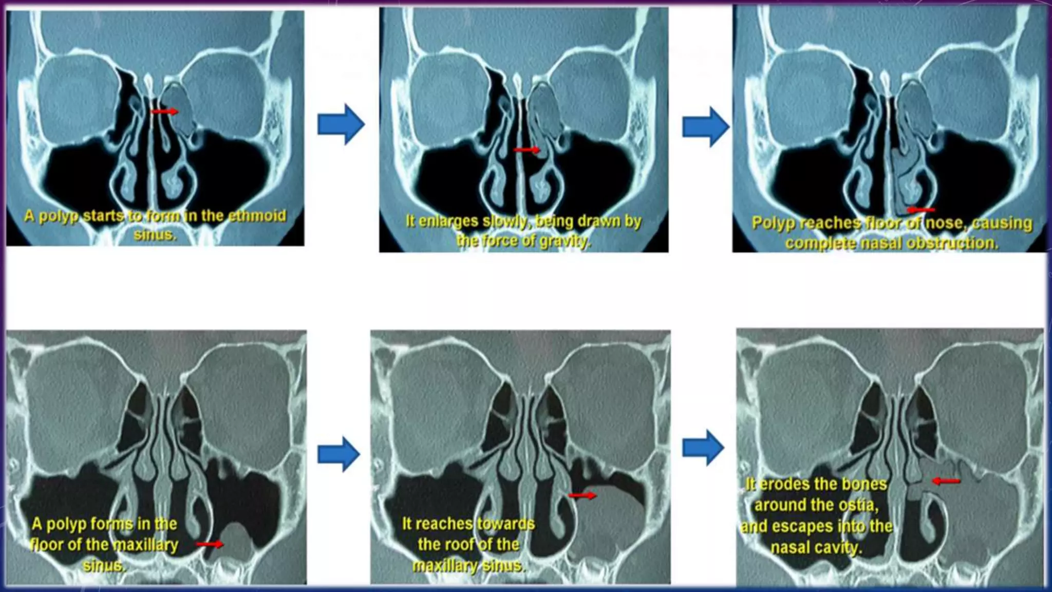 SINONASAL POLYPOSIS.pptx
