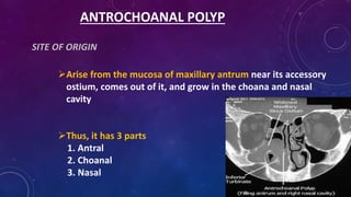 SINONASAL POLYPOSIS.pptx