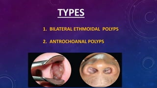 SINONASAL POLYPOSIS.pptx
