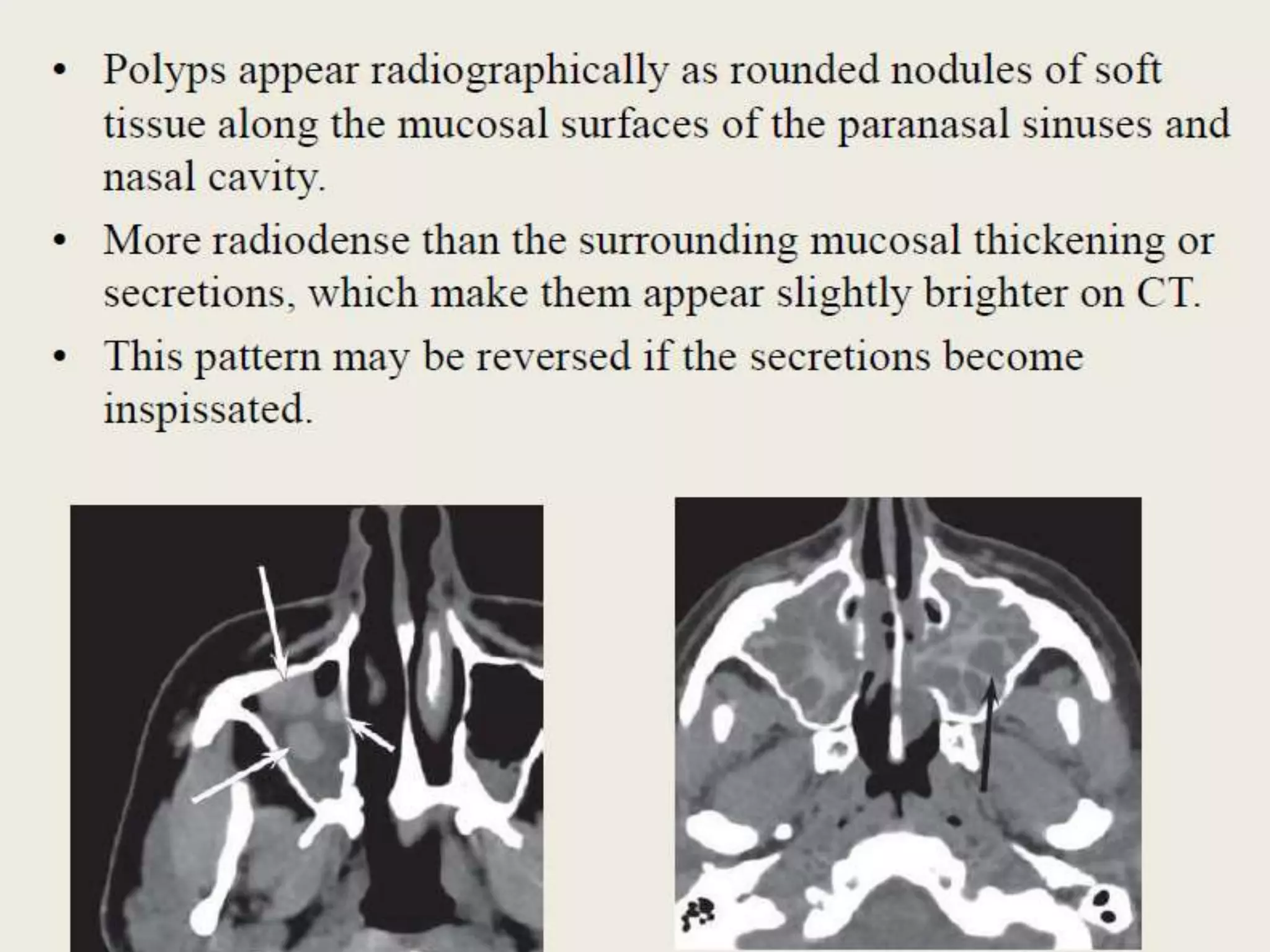 Sinonasal polyps | PPTX