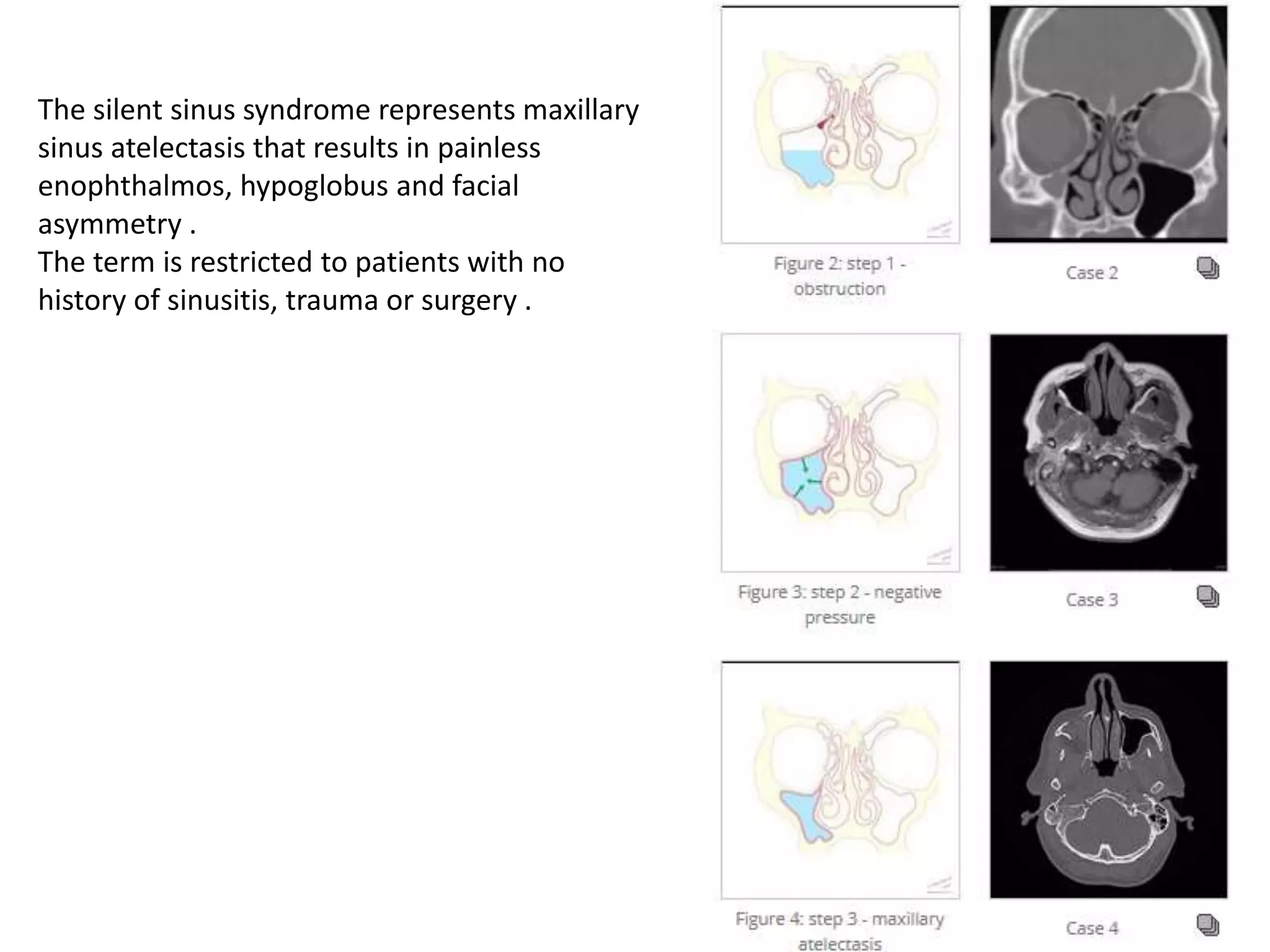 Sinonasal polyps | PPTX